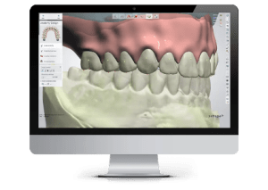 Digital Dentures in Scarborough & Port Hope | Apple Dentures